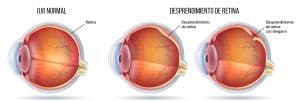 Desprendimiento de retina - Clínica de Oftalmología Sánchez Trancón
