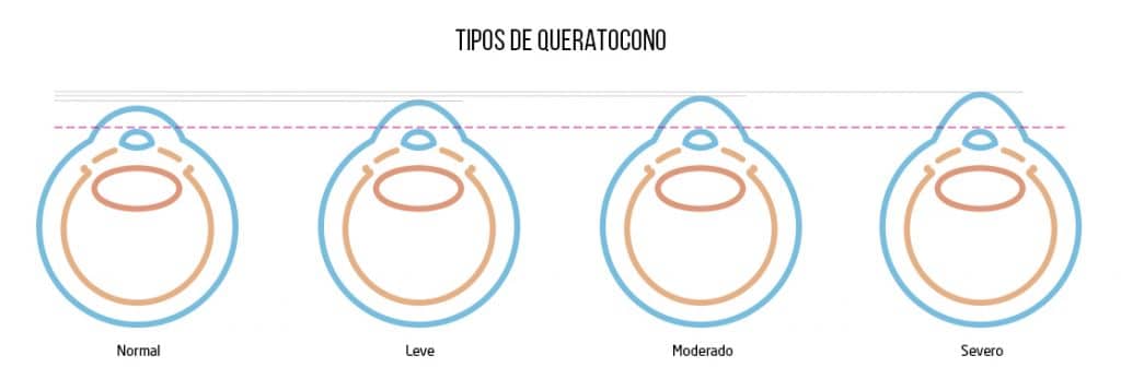 Queratocono - Clínica de Oftalmología Sánchez Trancón