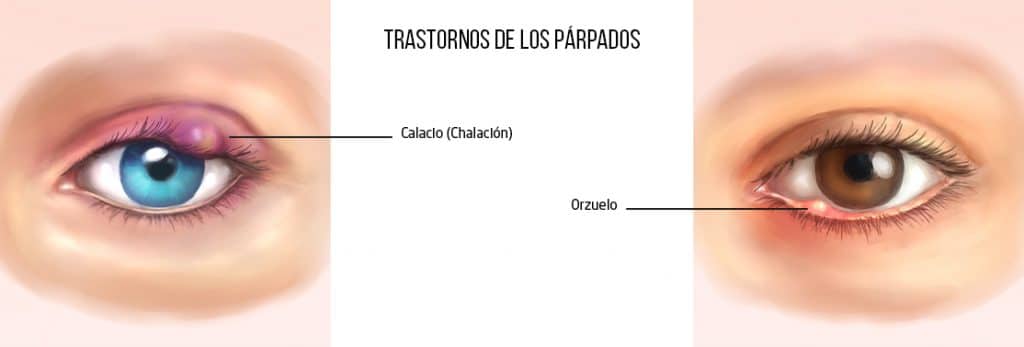 Trastornos de los párpados - Clínica de Oftalmología Sánchez Trancón