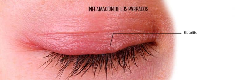 Trastornos de los párpados - Clínica de Oftalmología Sánchez Trancón