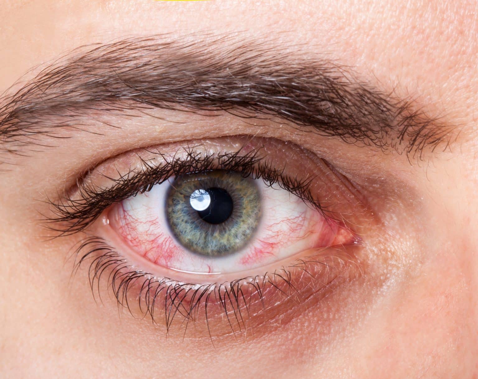 Derrame ocular , Lo que debes saber , sus causas, síntomas y tratamiento.